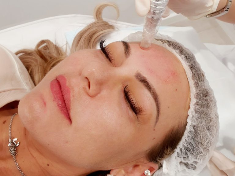 PRP Skin Rejuvenation - BioCell Hair Clinic Sydney PRP Skin